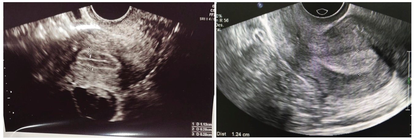 Ultrasonographic endometrial classification in In Vitro Fertilization ...