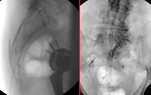 Enhanced Pain Relief with Catheter-Guided Caudal Epidural Steroid ...
