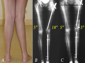 Surgical correction of valgus deformities of the knee in Polyostotic ...