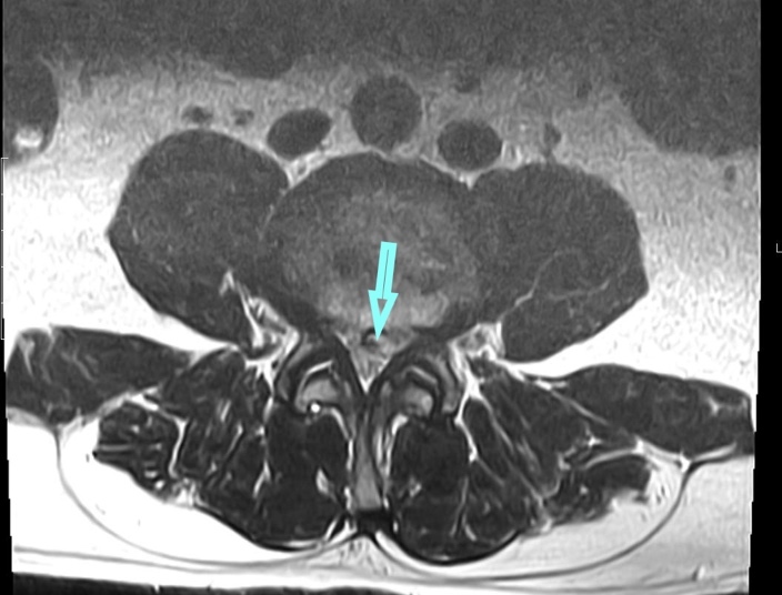 NON-SURGICAL CHIROPRACTIC MANAGEMENT OF A MASSIVE LUMBAR DISC EXTRUSION ...