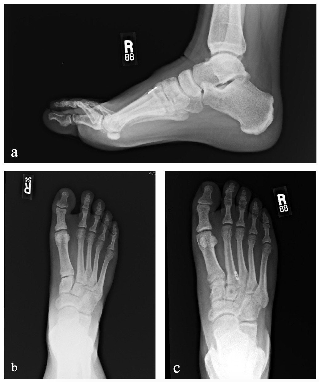 Outcomes of Lisfranc Injuries Treated with a New Flexible Fixation ...