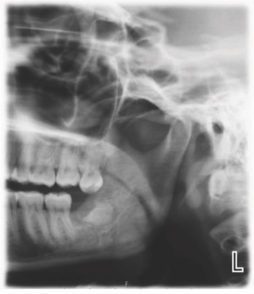 Coronectomy? A case report following coronectomy of a ‘high-risk ...