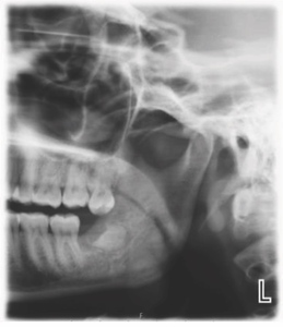 Coronectomy? A case report following coronectomy of a ‘high-risk ...