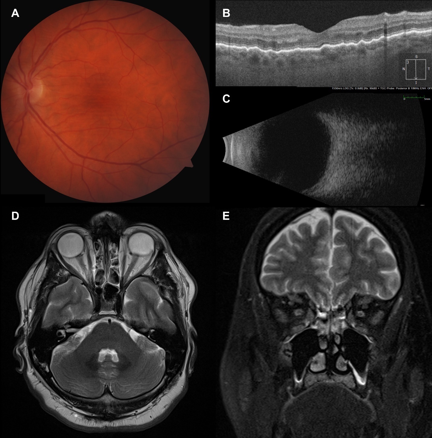 A Case Series of Chorioretinal and Choroidal Folds | Published in ...