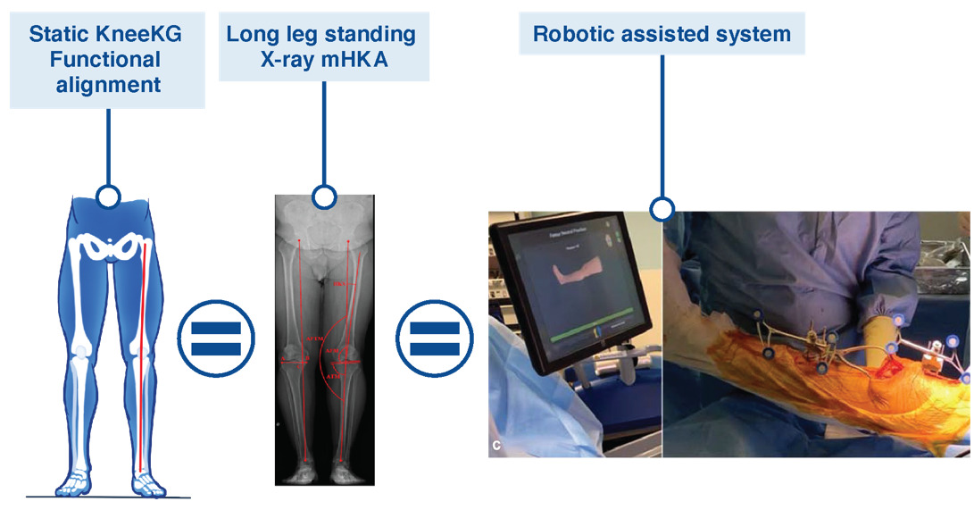 A New Paradigm in the Management of Knee Osteoarthritis and ...