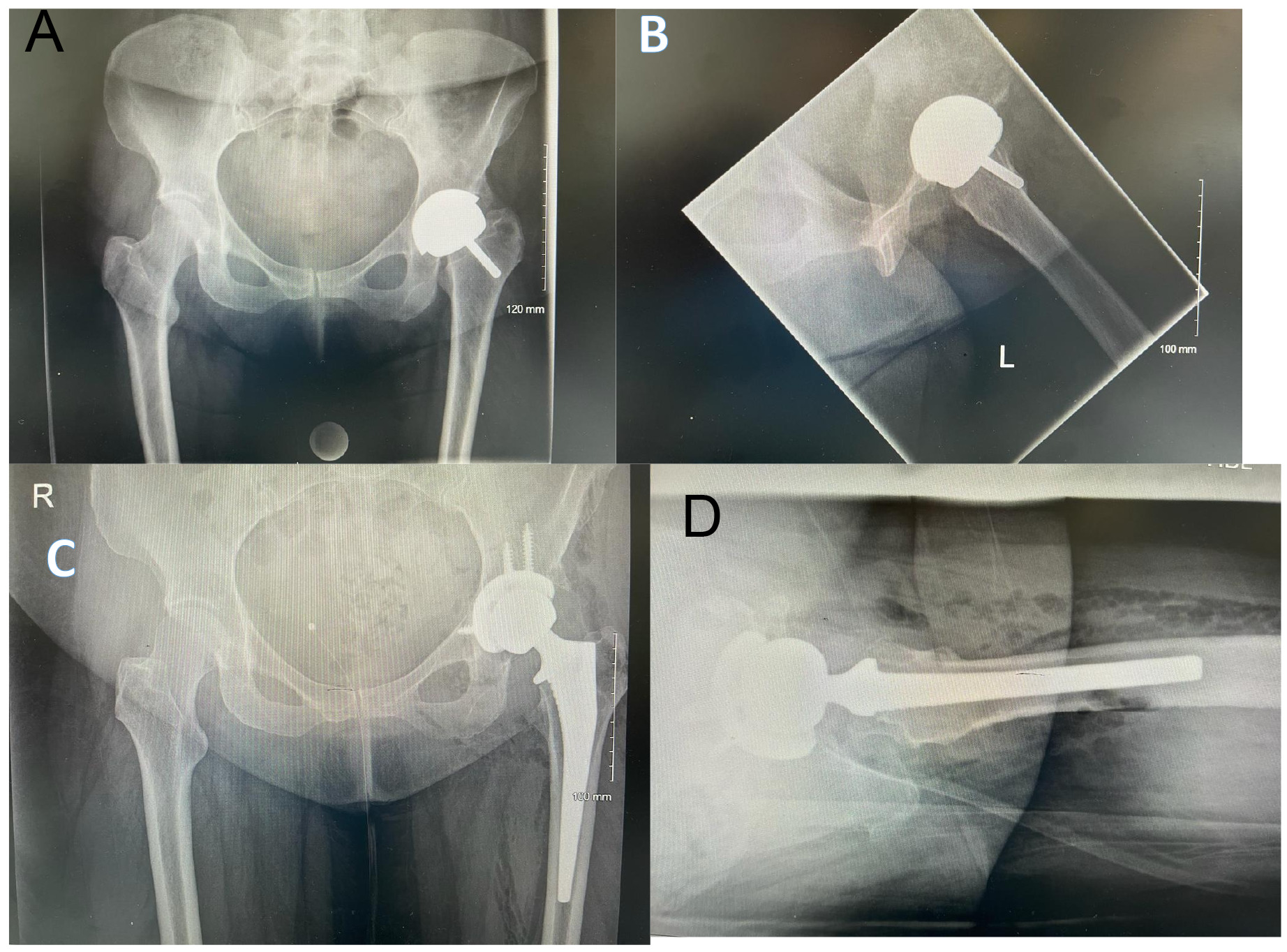 Bipolar Hemiarthroplasty Vs Total Hip Replacement Bipolar Hemiarthroplasty Vs Total Hip Replacement