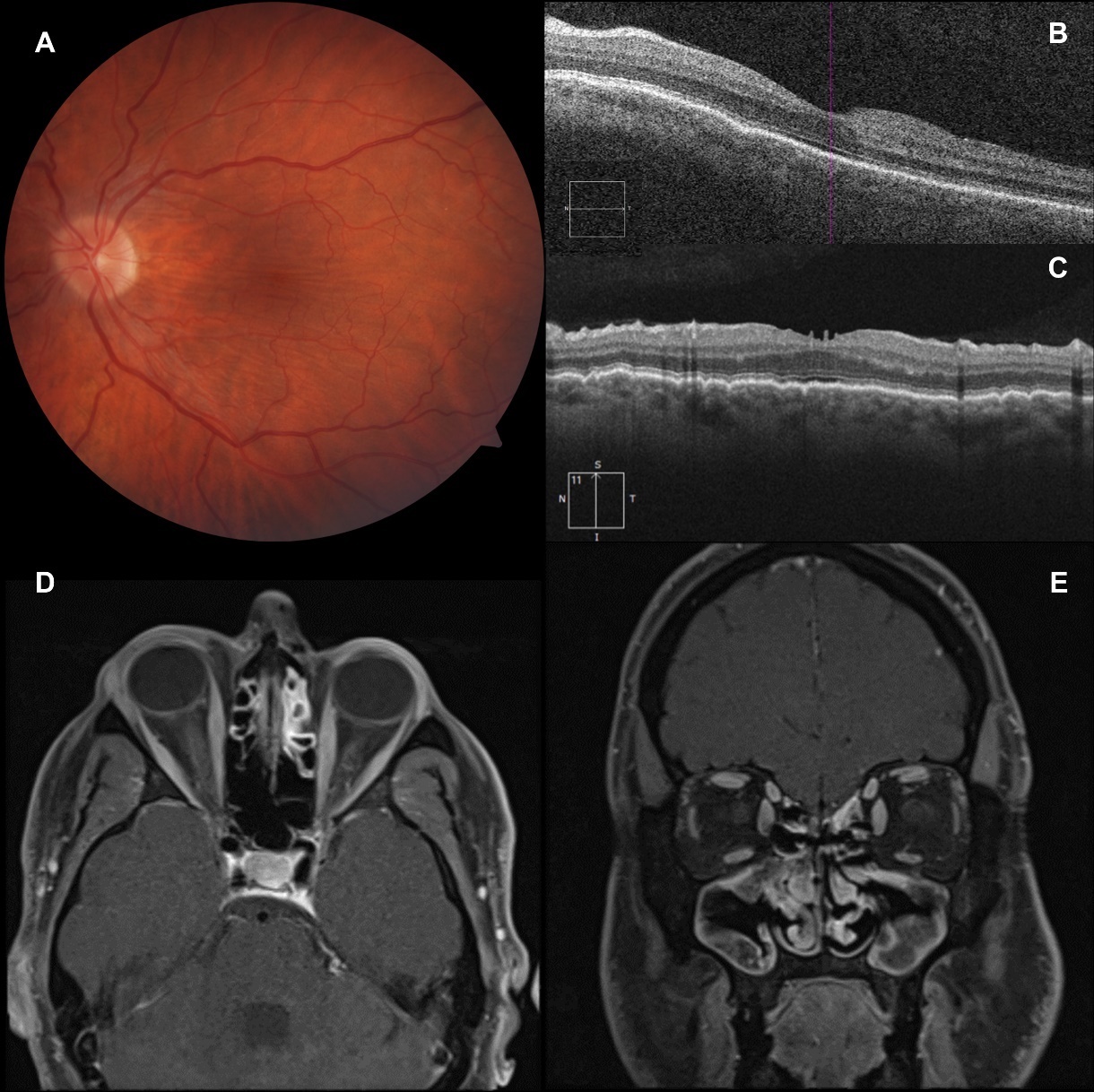 A Case Series of Chorioretinal and Choroidal Folds | Published in ...