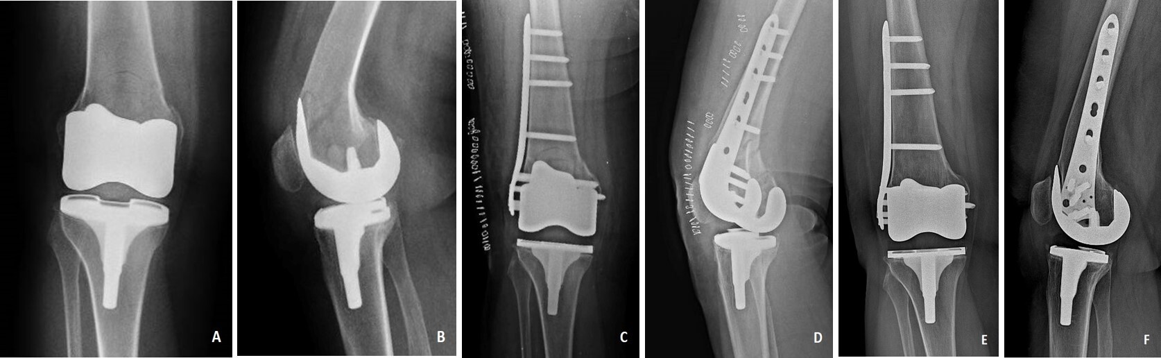 Periprosthetic distal femoral fractures after total knee replacement treated by ORIF. Mid to ...