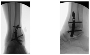 A New Technique For Tibiotalar Arthrodesis: Shotel Ankle Arthrodesis ...