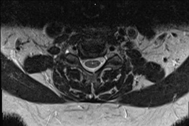 NON-SURGICAL SPINAL DECOMPRESSION IN POST-TRAUMATIC SYRINGOMYELIA: A ...