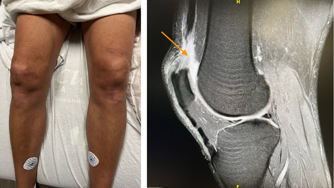Quadriceps Tendon Rupture Quadriceps Repair And Patellar Tendon Tear