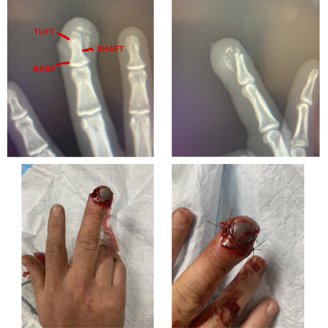 missing distal phalanx