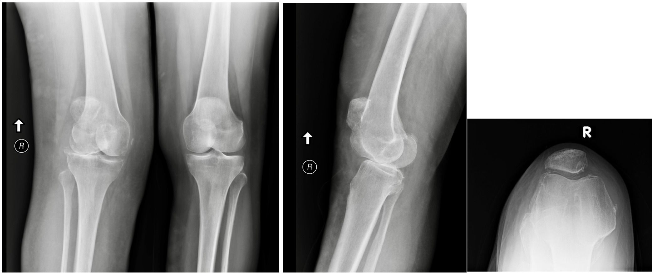 Robotic Assisted Total Knee Arthroplasty in Arthrofibrosis or the ...