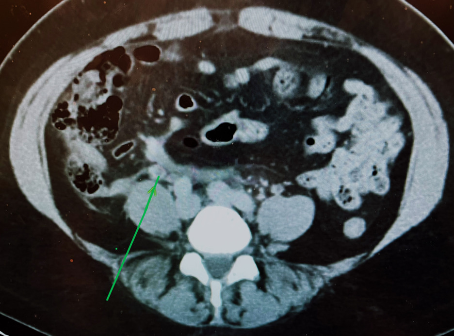 Partial right gonadal vein thrombosis after uterine fibroid ...