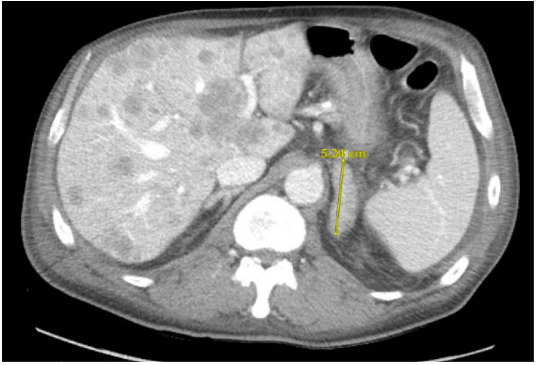 Ectopic Cushing’s Syndrome as the First Presenting Sign of Small Cell ...