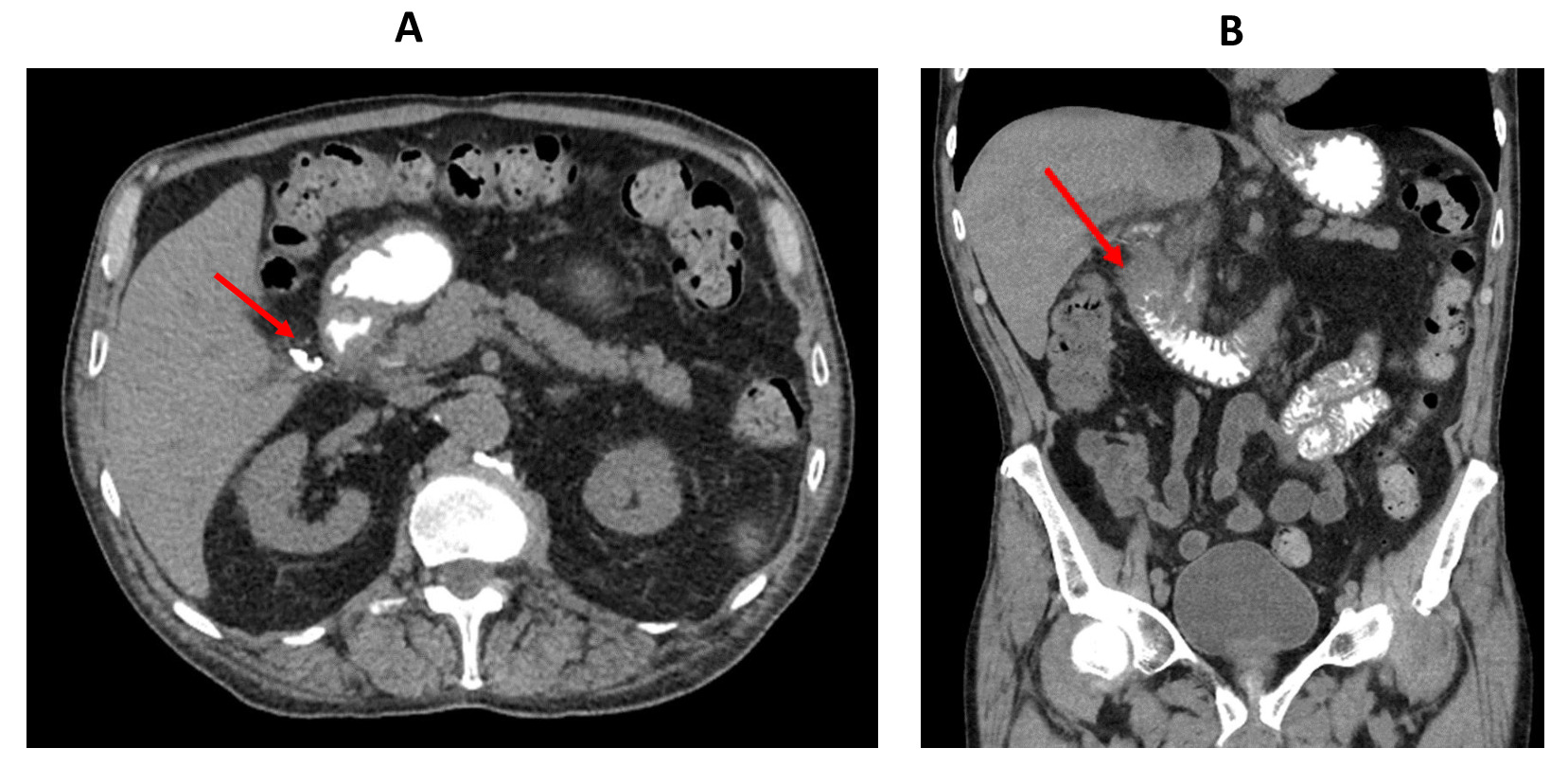 Lyme carditis complicating the presentation of a perforated duodenal ...