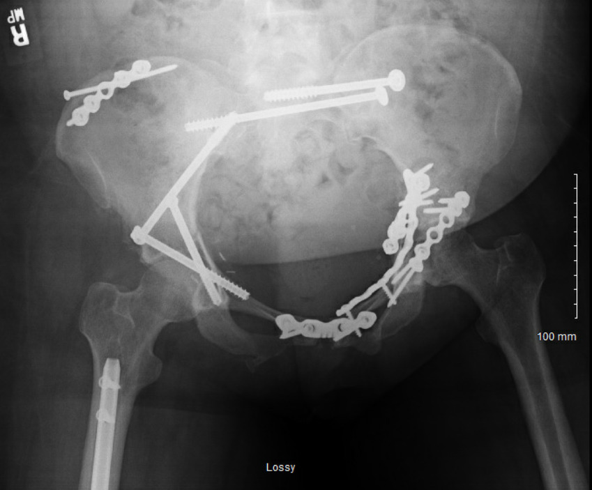 Complete Traumatic Laceration of the Sciatic Nerve Secondary to ...