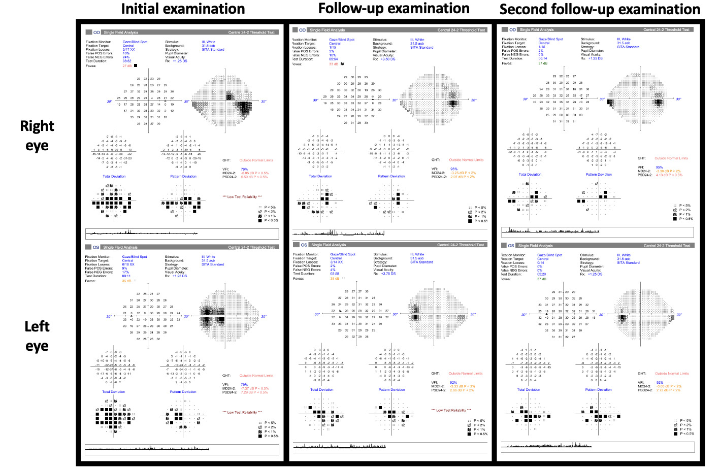 A Case Report of Papilledema Secondary to Hemangioblastoma | Published ...