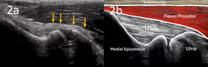 The Use of MSK Ultrasound in the Evaluation of Elbow Ulnar Collateral ...