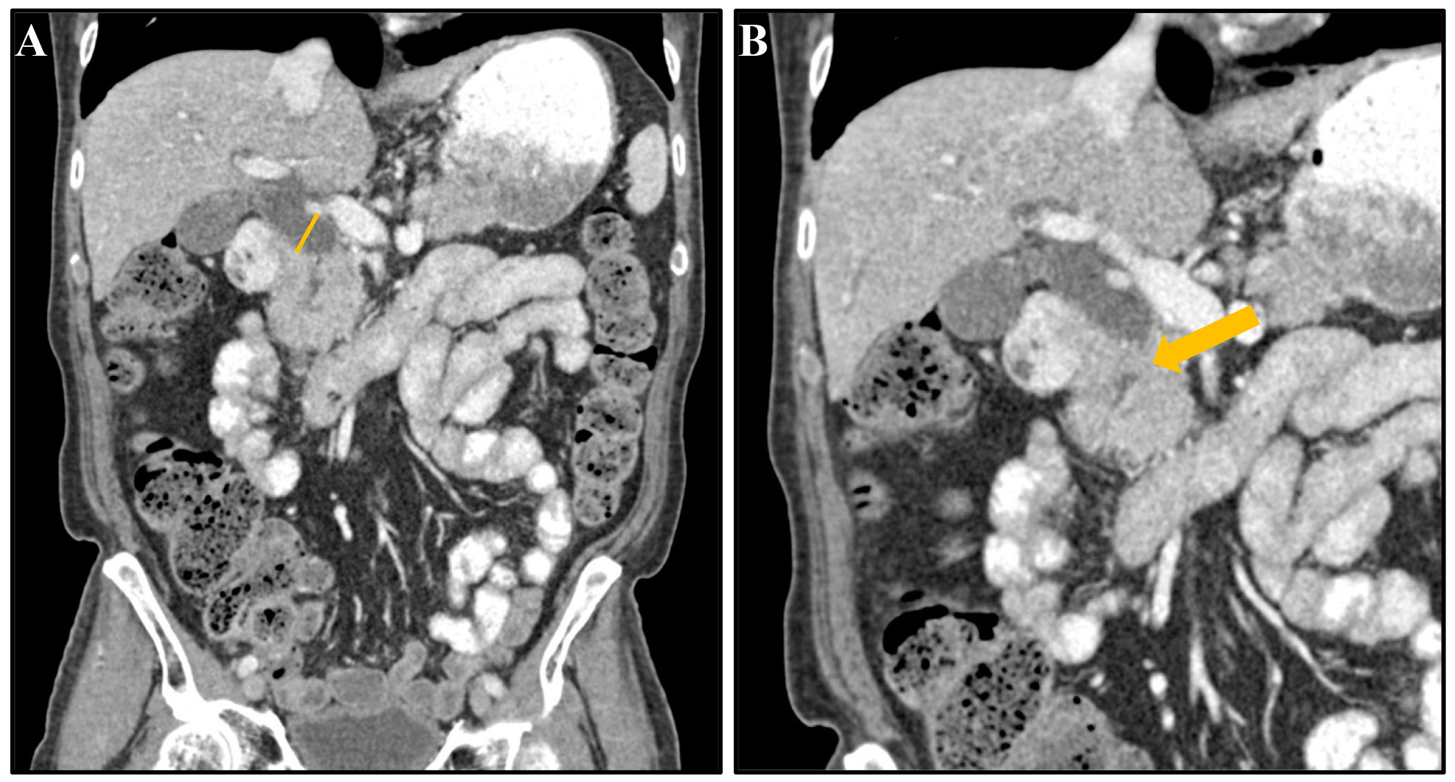 A Diagnostic Paradox: Identifying IgG4-Related Disease in a Patient ...