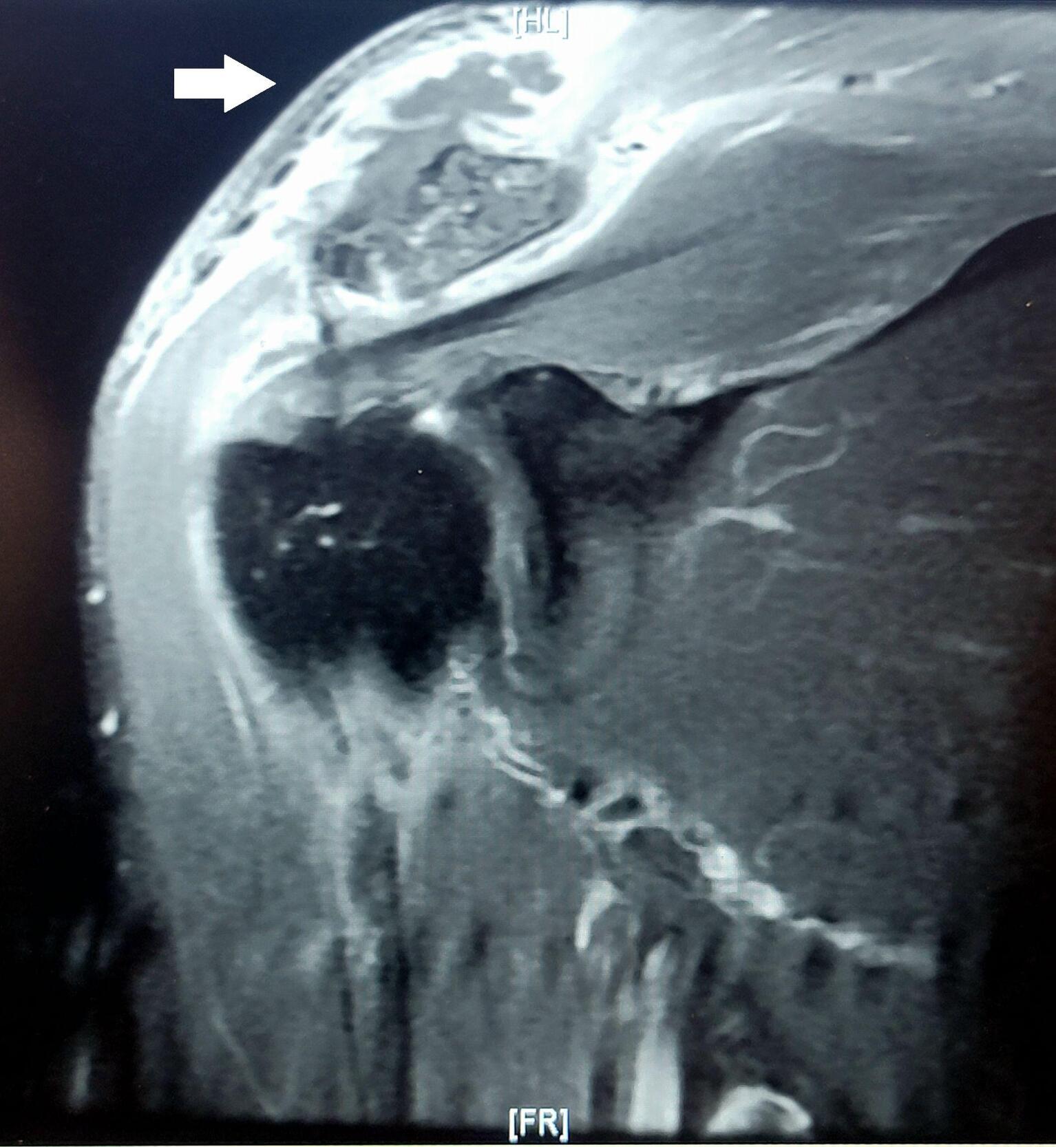 Shoulder Mri Without Contrast