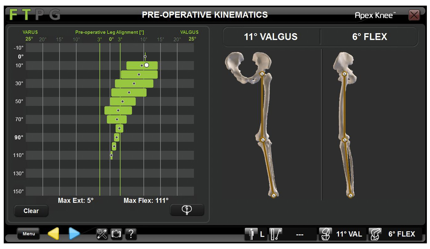 Total Knee Arthroplasty in Valgus Deformity Made Easy Using Robotic ...