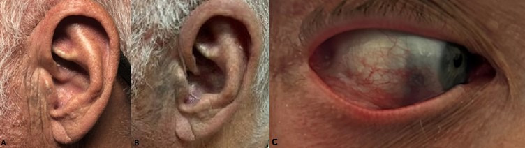 Conjunctival and Macular Hyperpigmentation Associated with ...