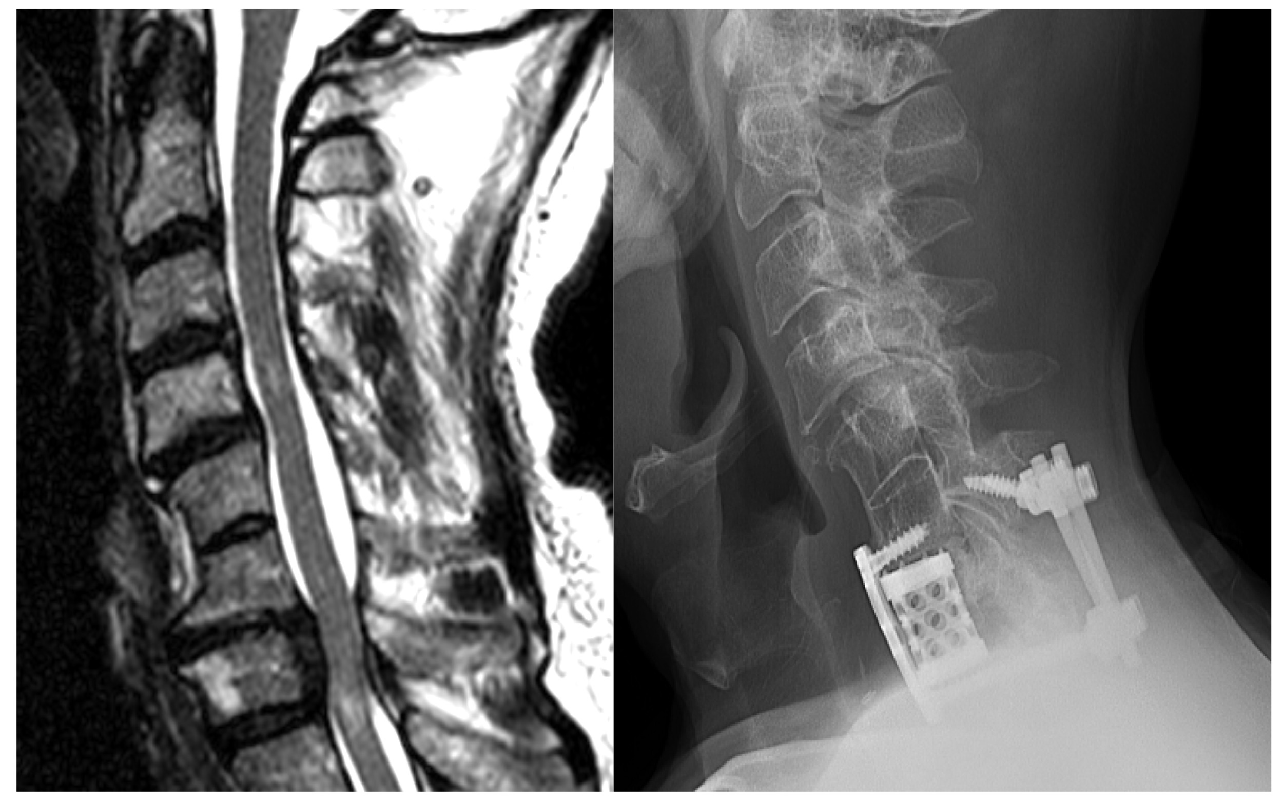 Cervical Myelopathy: Diagnosis and Surgical Strategies | Published in ...