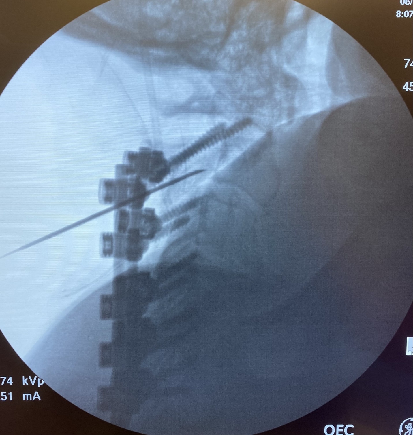 Case Report: Percutaneous Peripheral Nerve Stimulation for the ...