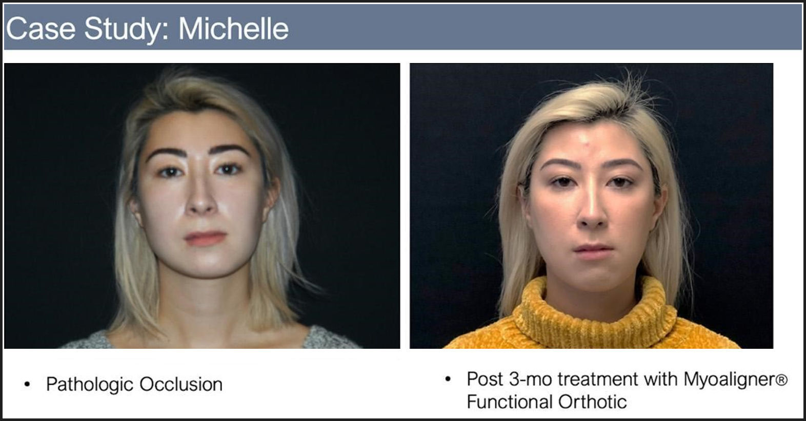 MyoalignerⓇ: An innovative approach to Occlusion, TMD and Airway Treatment: A case Study ...