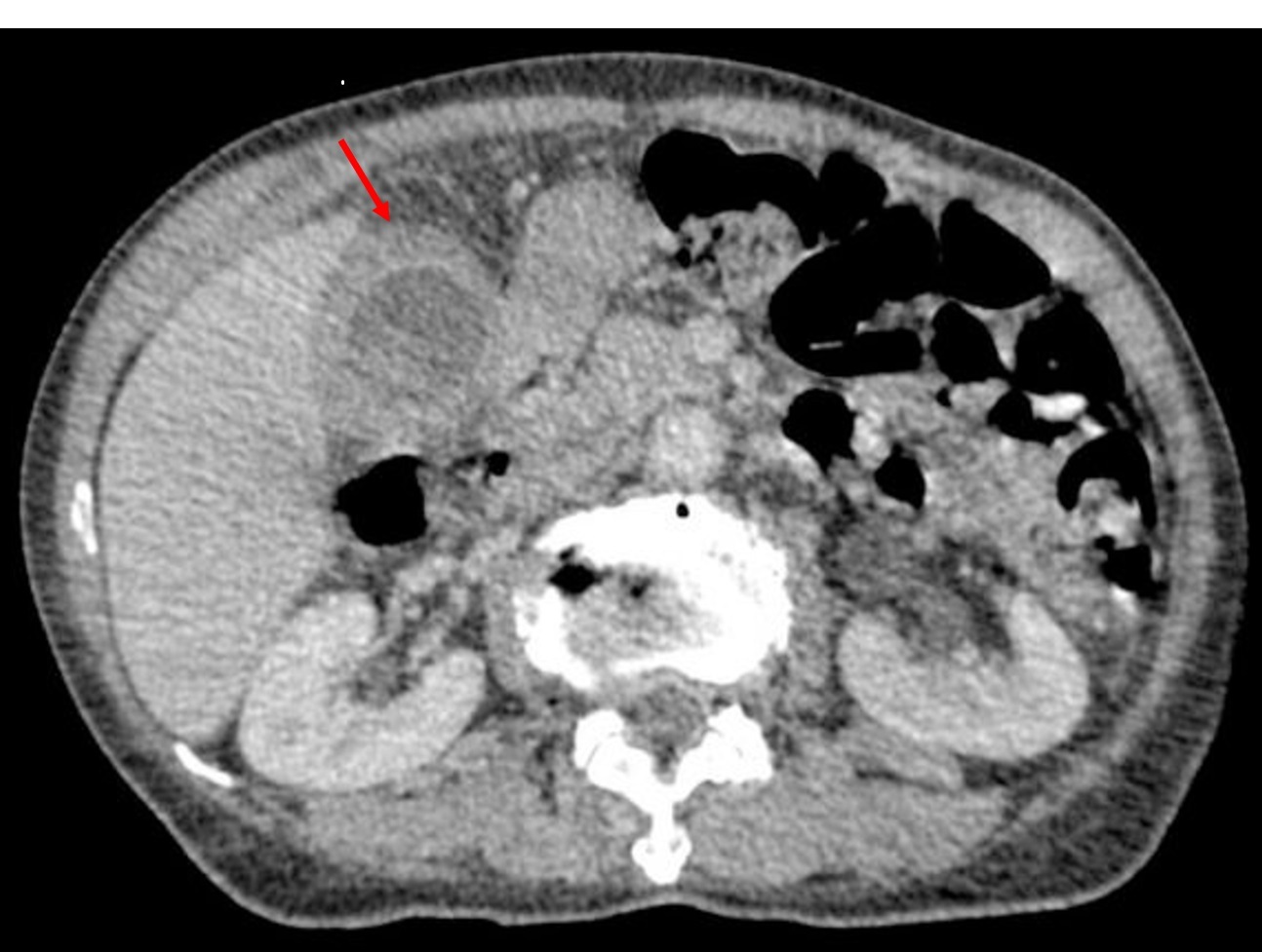 An overview of the management of gallbladder perforations. | Published ...