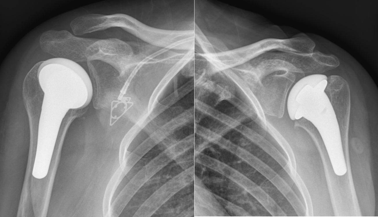 Review of Pyrocarbon Shoulder Hemiarthroplasty: Advances in Shoulder ...