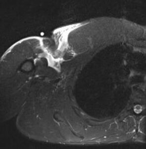 Injuries of the Pectoralis Major: Diagnosis and Management | Published ...