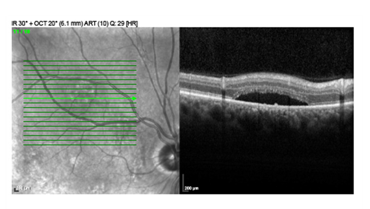 Chronic Serous Chorioretinopathy: A Case Study | Published in CRO ...