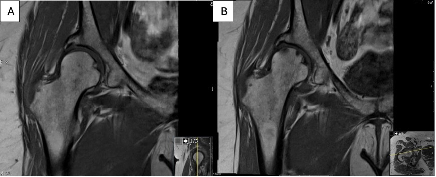 Avascular Necrosis and Subchondral Collapse of the Femoral Head After ...