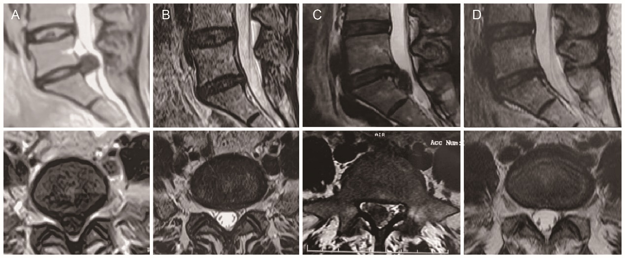 Prevalence, clinical predictors, and mechanisms of resorption in lumbar ...