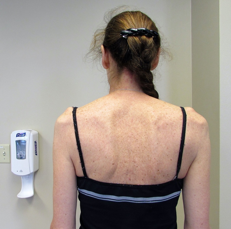 Post-operative Rehabilitation for Scapular Muscle Reattachment: A Case ...