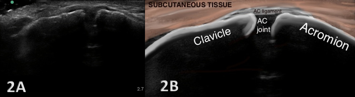 MSK Diagnostic Ultrasound for the Assessment of the Acromioclavicular ...