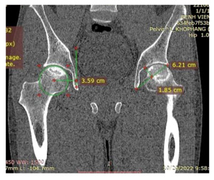 Morphological Characteristics of the Vietnamese Adult Human Acetabulum ...