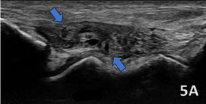 Diagnostic Musculoskeletal Ultrasound in the Evaluation of the Deltoid ...