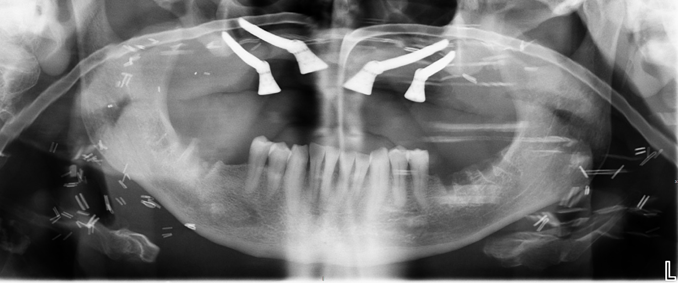 The Zygomatic Implant Perforated (ZIP) flap for rehabilitation of ...