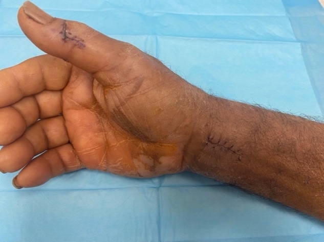 Acute Carpal Tunnel Syndrome Secondary to Reactive Tenosynovitis ...