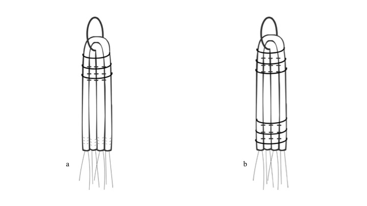 Hamstring Graft Preparation for ACL Reconstruction | Published in ...