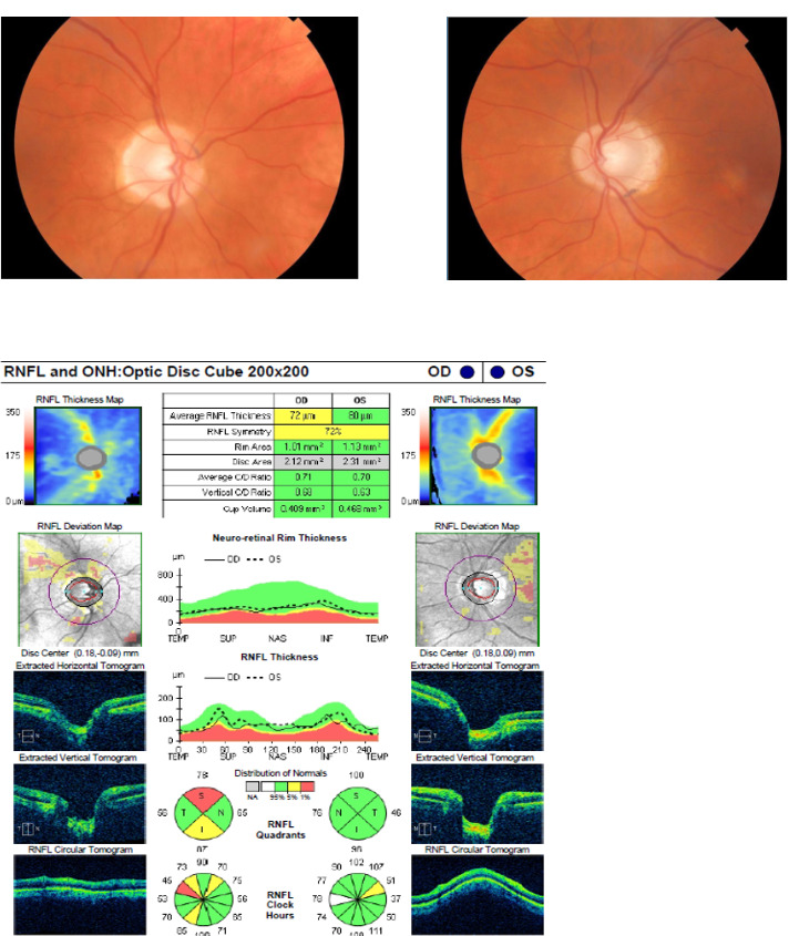 Case Report: Posterior Radiation Optic Neuropathy | Published in ...
