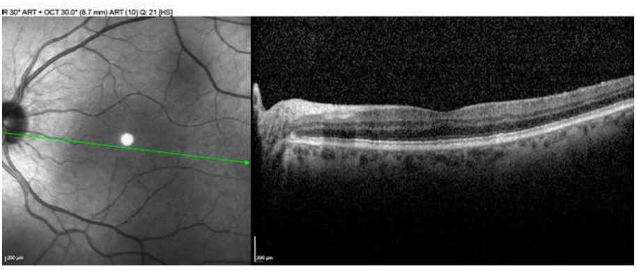 Ocular Argyrosis Secondary to Long-term Ingestion of Self-Concocted ...