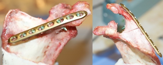 Biomechanical comparison of single versus double plate osteosynthesis ...