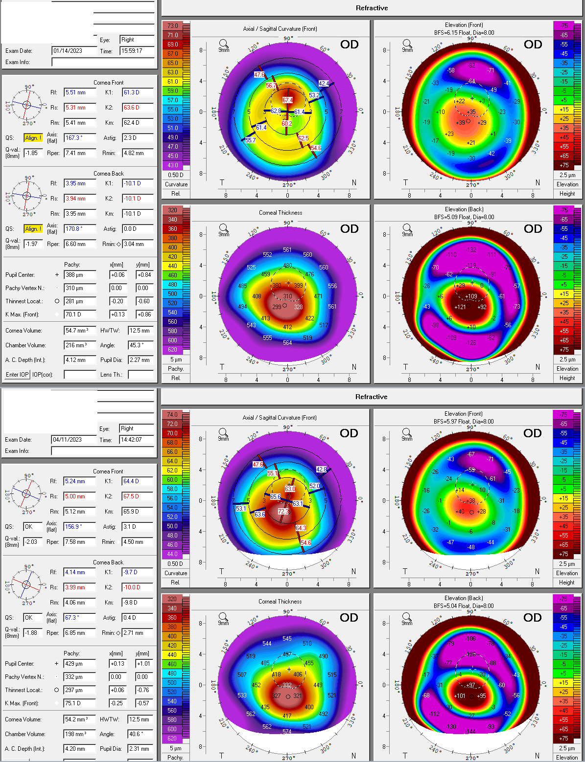 Case Report: A Changing and Fragile Landscape—Contact Lens Fitting ...