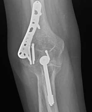 Capitellum Fracture: Surgical Exposure and Fixation Strategies ...