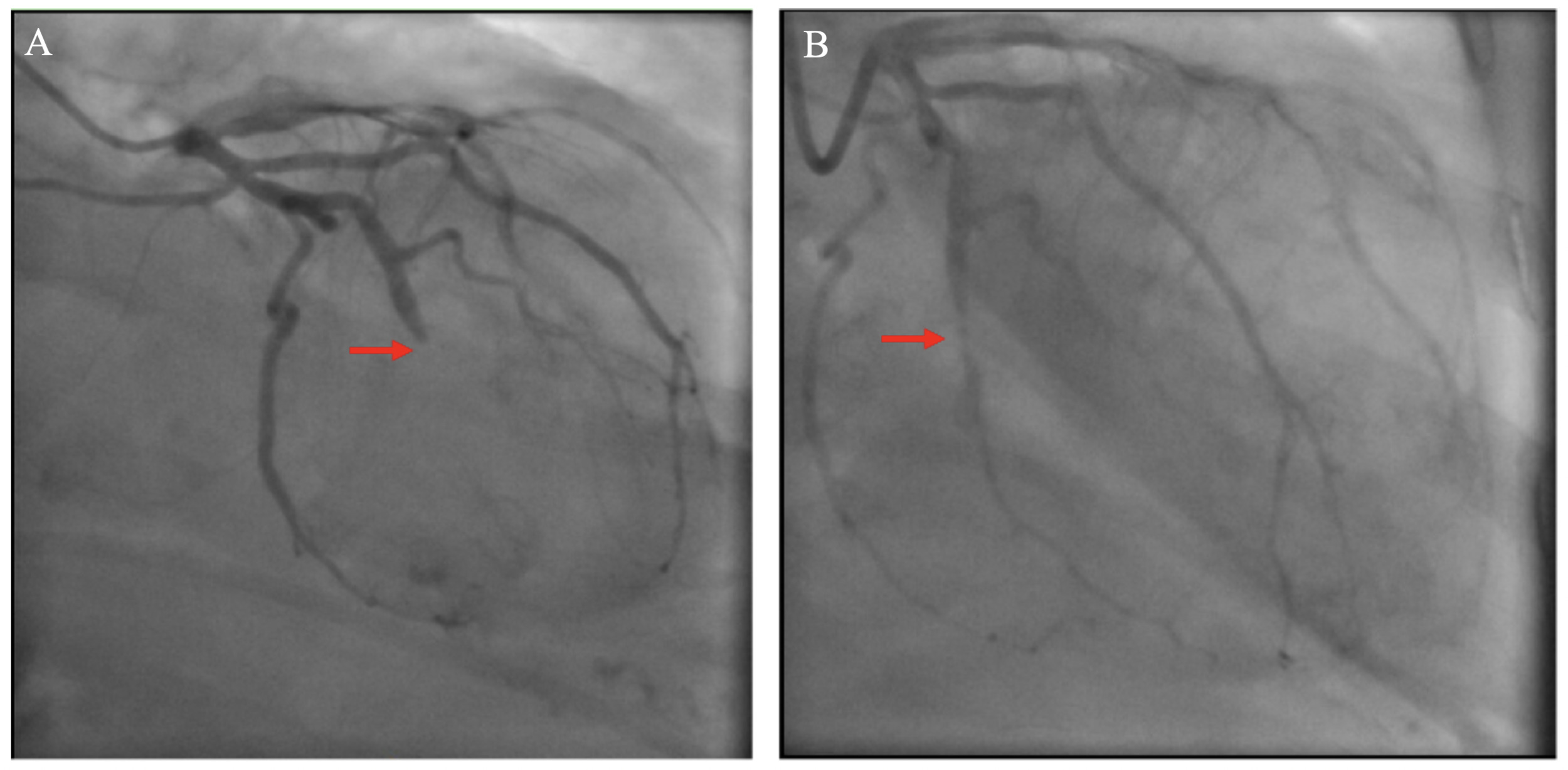 Posterior Occlusive Myocardial Infarction on Chronic Right Bundle ...