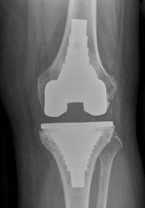Mechanisms of bone loss in revision total knee arthroplasty and current ...